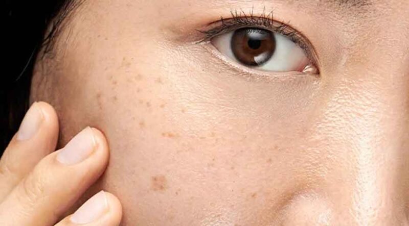 Why Some Dark Spots Fade Fast While Others Stick Around - The Curiously ...